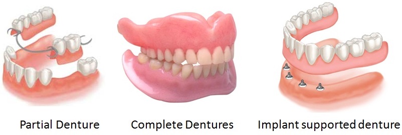 Dentures – Pennyhill Dental Care